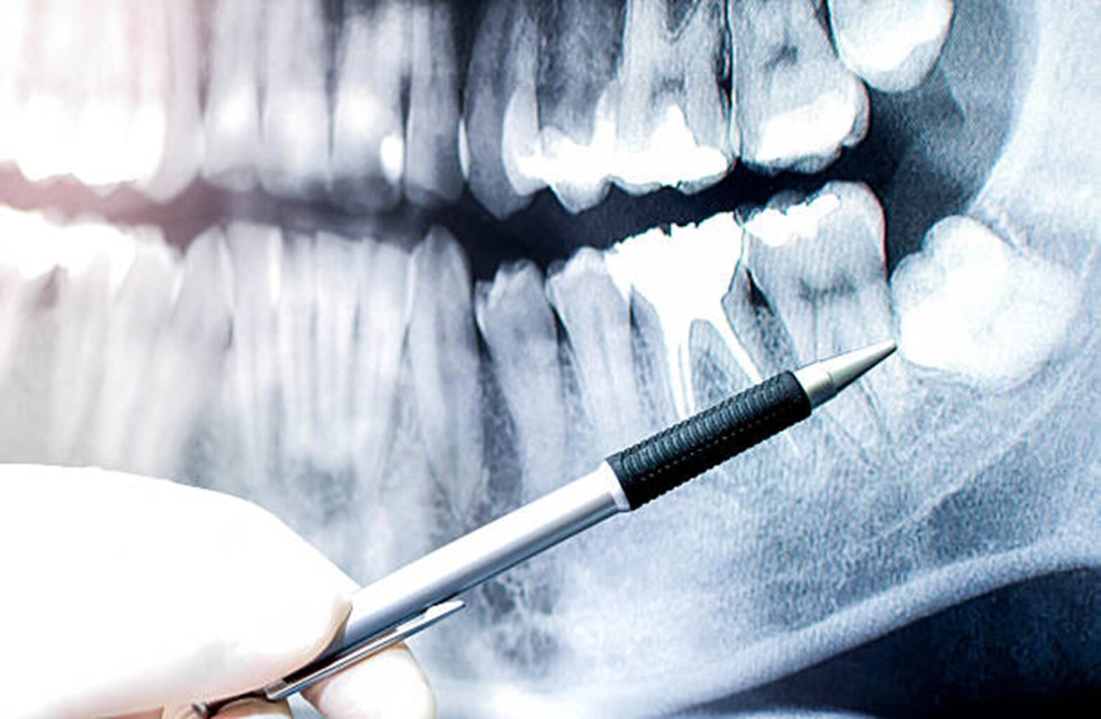 Wisdom Tooth Extraction: Answering Your FAQs - Smile Circle Blog